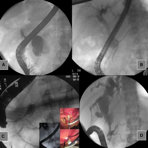 ERCP Showing PBM And Ansa Pancreatica In A 28 Year Old Male Patient Download Scientific Diagram