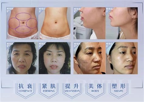 给你做7d聚拉提十大理由 广州市欣姿美容仪器有限公司