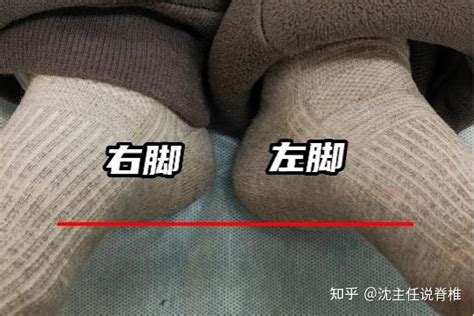 长短腿也有真假，你知道吗？一文详细了解！ 知乎