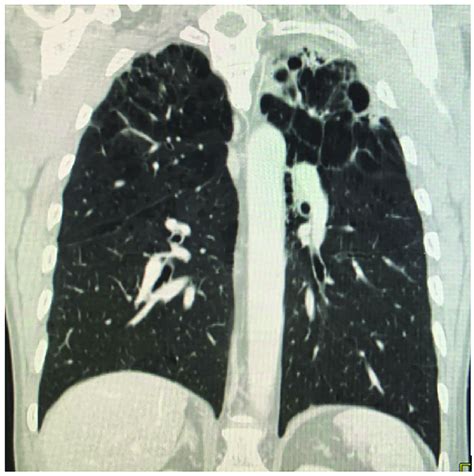 Primary Ct Of The Chest Displaying A Multiloculated Abscess In The Left
