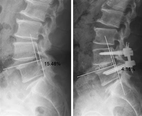 Slip Measurement Slip Percentage Is Expressed As The Percentage Of The Download Scientific
