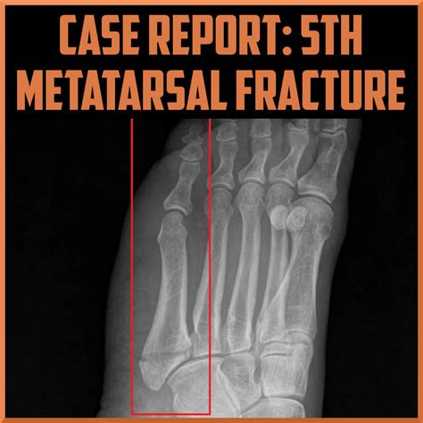 Case Report Fifth Metatarsal Fracture Foppacasa