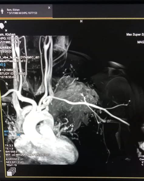 Mri Brachial Plexus Patient Has History Of Left Side Weakness Soft Tissue Sarcoma Siemens