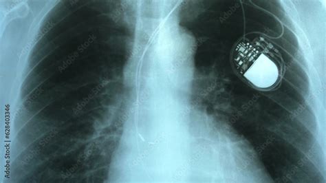 Doctor Examining X Ray Image Of Chest With Artificial Cardiac Pacemaker