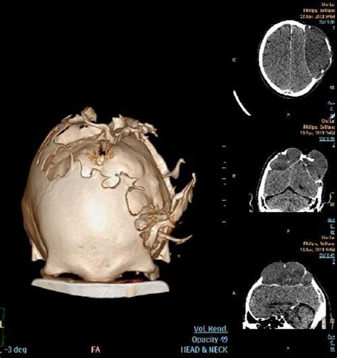 volume rendering technique of the computed tomography ct scan in the