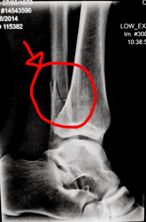 Fratura De Fibula Cid BRAINCP