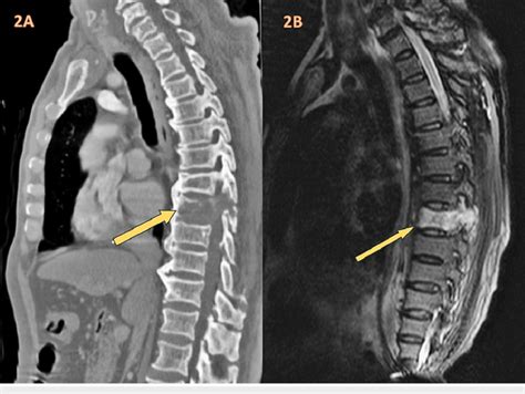 A Axial Spine Ct Scan Revealing Metastatic Lesion And B Axial Spine Download Scientific