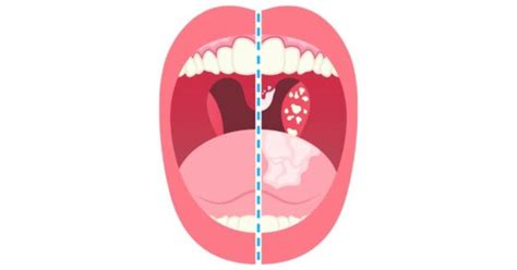 Tonsilitis Radang Amandel Gejala Penyebab Cara Mengobati Blog Rey