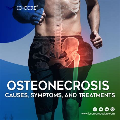 Osteonecrosis Causes Symptoms And Treatments Io Core