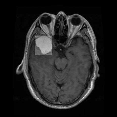 Brain Tumor Object Detection Model By Computer Vision