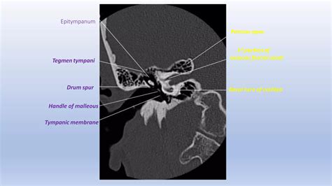 Hrct Temporal Bone Pk1 Ppt Pptx
