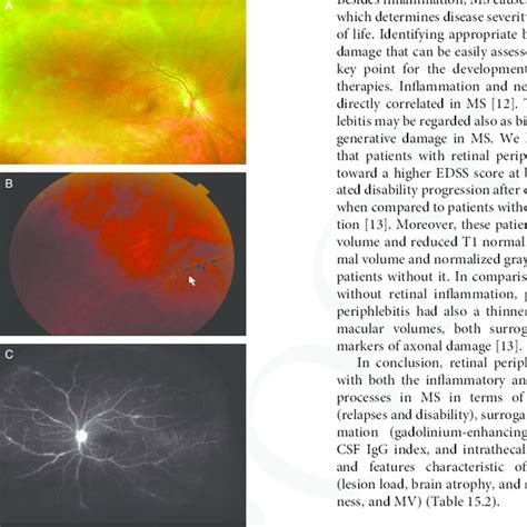 Pdf Retinal Inflammation In Multiple Sclerosis Revealed By Optical