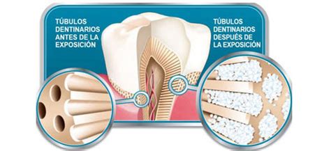 Tudo O Que Precisa De Saber Sobre Os Dessensibilizantes Dentários