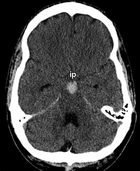 Interpeduncular Cistern Hemorrhage
