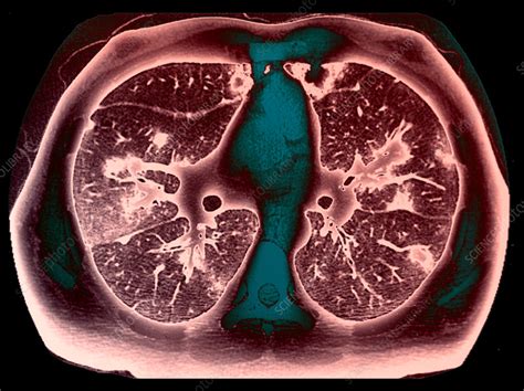 Lung Cancer Ct Scan Stock Image C057 7975 Science Photo Library