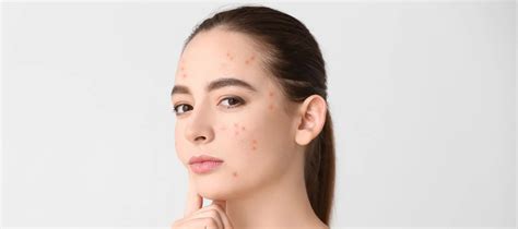 Skin Problems During Pregnancy How To Tackle Face Skin Issues The