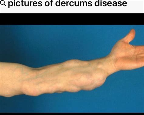 Dercums Disease