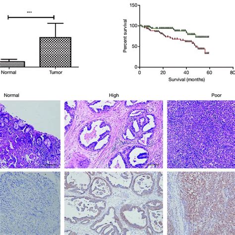 Rab25 Predicts Poor Prognosis In Gastric Adenocarcinoma A Comparison