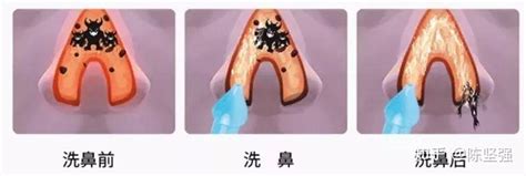 鼻炎患者【自救指南】，洗鼻器的选购与使用经验分享 知乎