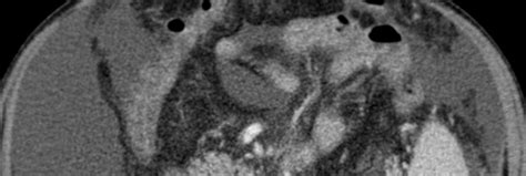 Axial Contrast Enhanced Ct Shows Enlarged Left Gastric Vein Red Arrow