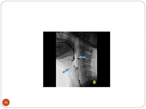 Physiology Swallowing And Functional Investigations Of Upper Git Pptx