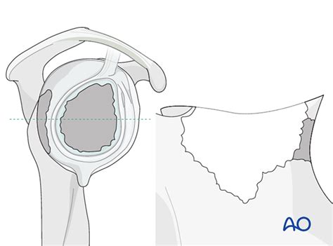 Revision Of An Anatomic All Polyethylene Glenoid Component For Glenoid Implant Loose Good Bone