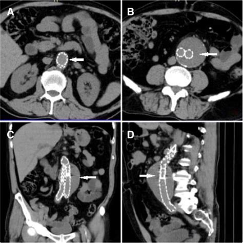 A Abdominal Computed Tomography Transverse Section After Endovascular