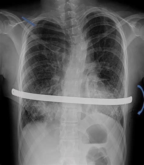 Surfactant Protein C Deficiency Associated Diffuse Lung Disease