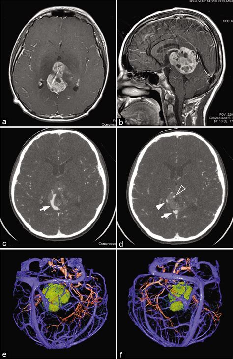 Surgical Neurology International