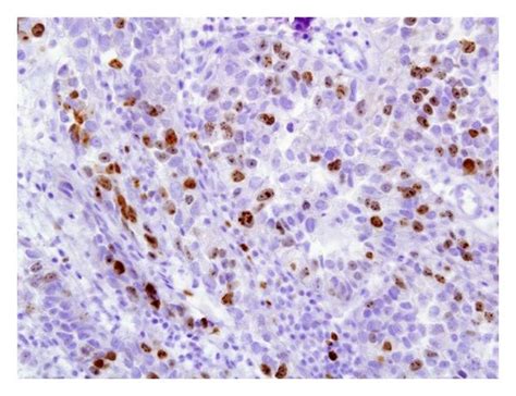 Immunohistochemical Staining Of Clear Cell Adenocarcinoma Showing