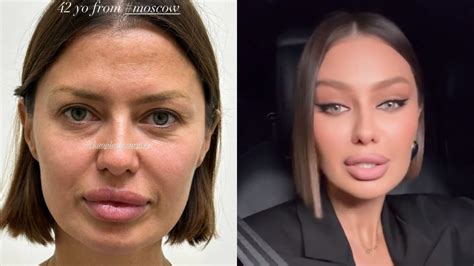 «Я выбрала борьбу за красоту 10 российских звезд довольных результатами своей пластики