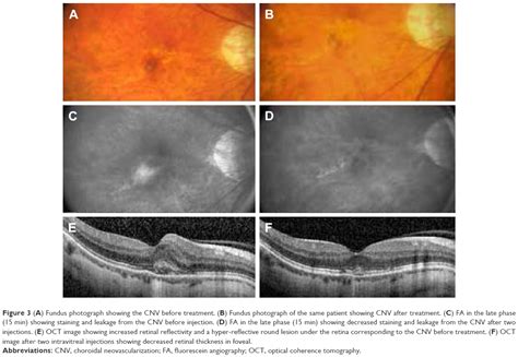 Intravitreal Aflibercept For The Treatment Of Choroidal Neovasculariza Opth