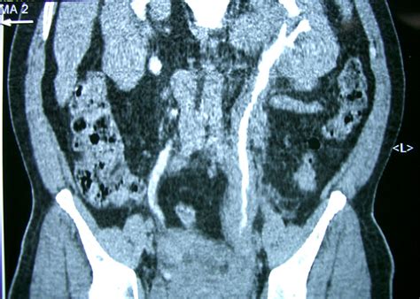 Coronal Reformatting Of The Computed Tomography Images In Fig 1
