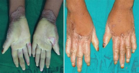Transgradient Palmoplantar Keratoderma With Sharp Margins Conical Download Scientific Diagram Transgradient Palmoplantar Keratoderma With Sharp Margins Conical Download Scientific Diagram