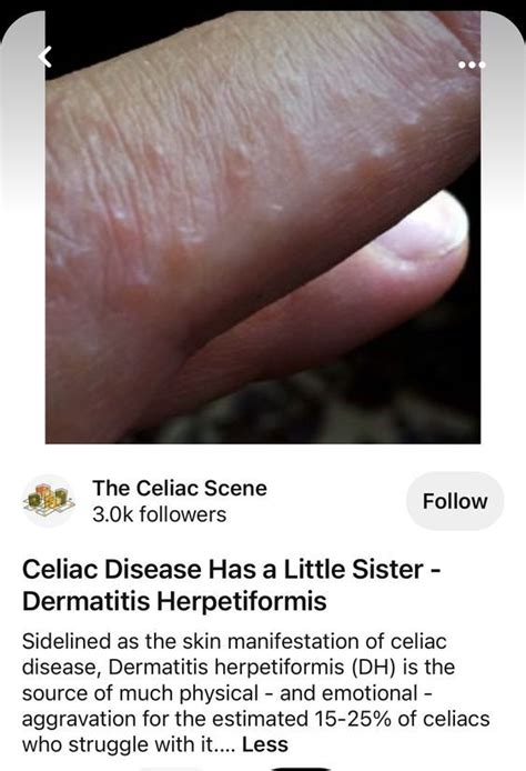 22 Photos That Show What Mast Cell Activation Disorder Looks Like Artofit