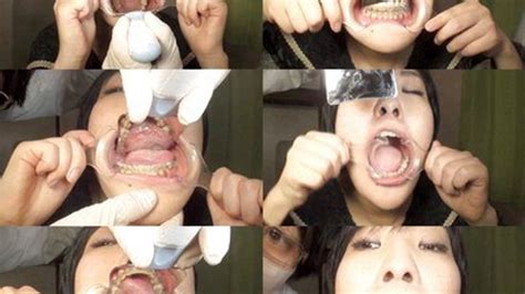 Removing Braces 101 Part 4 High Resolution Avi Format Deviant