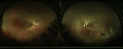 Wide Field Fundus Photographs Show Decreasing Size Of Choroidal