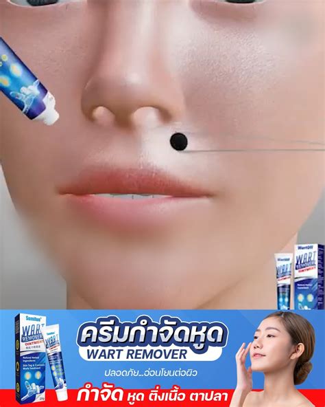 🎀 บอกลา หูด ติ่งเนื้อ ตาปลา 🎀 ปลอดภัยและอ่อนโยน ผิวกลับมาเรียบเนียน🎀