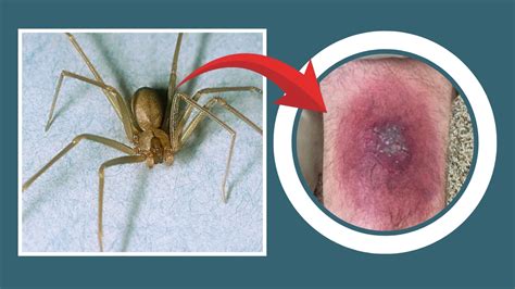 Brown Recluse Spider Bite Bruise What You Should Do