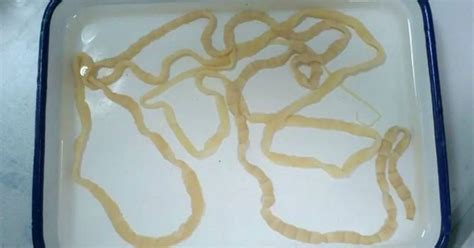 Pictured The 8ft Tapeworm Removed From Womans Stomach After Dodgy