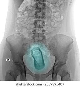 Foreign Body Radiography Photos Images Pictures Shutterstock