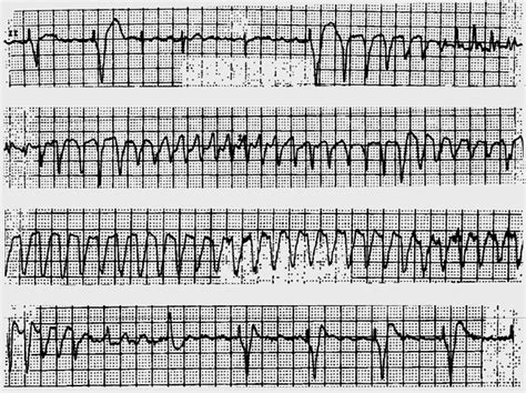 Pitfalls Of Pacemaker Detection Of Ventricular High Rate Events Pmc