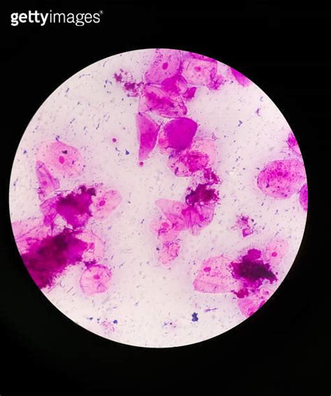 High Vaginal Swab Hvs Gram Stain Microscopic 100x Show Few Pus Cells