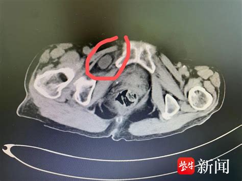肠子掉到大腿根这种罕见病老医生30年只见过两次