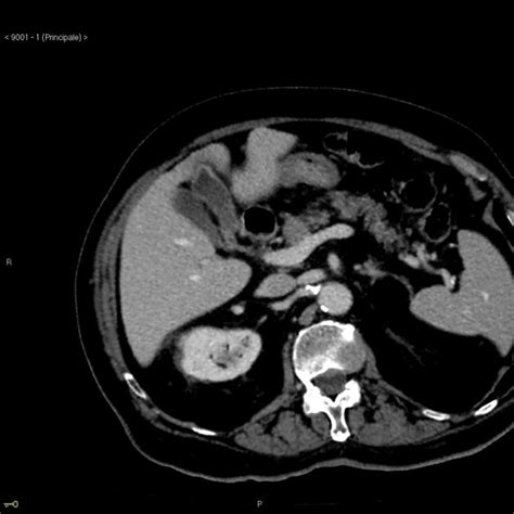 Gallbladder Duplication Pacs