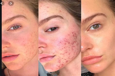 Eritretin Jel Yüzde Kaç Saat Kalmalı Güncel Oku