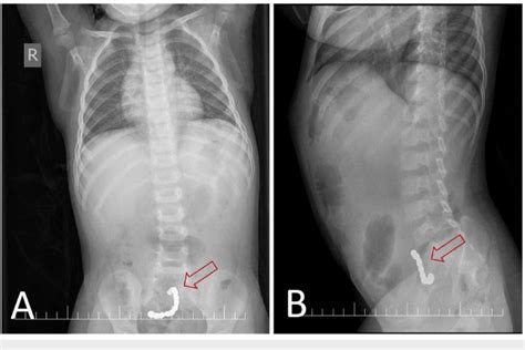 Ruptured Appendix X Ray Pediatric Appendectomy Overview