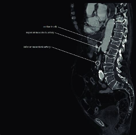 Angio Ct Scan Of The Abdomen Showing Distended Transverse Colon