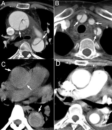 Dissection Type A Classic Type A Aortic Dissection With Visible
