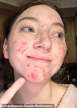 Scab Picking Disorder